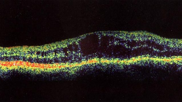 Cystoid Macular Edema - South Bay Ophthalmology