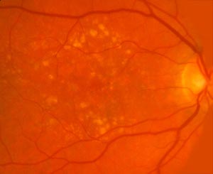 Macular Degeneration - South Bay Ophthalmology