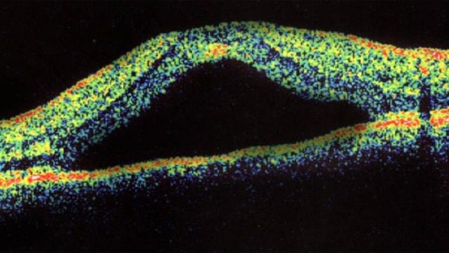 Central Serous Retinopathy - South Bay Ophthalmology