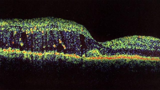 Optical Coherence Tomography OCT – Retina & Optic Nerve Scan - South ...