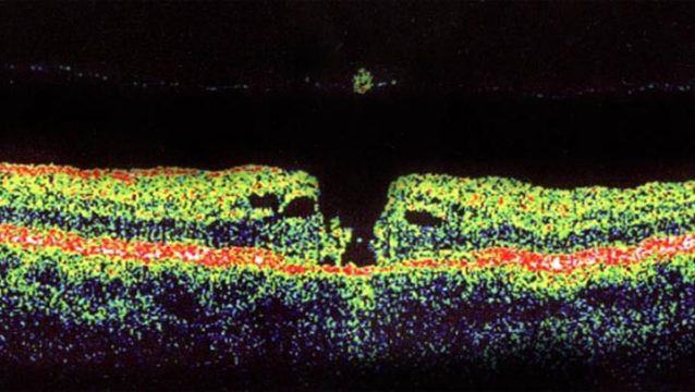 Optical Coherence Tomography OCT – Retina & Optic Nerve Scan - South ...