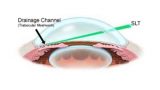 Selective Laser Trabeculoplasty (SLT) for Glaucoma - South Bay ...