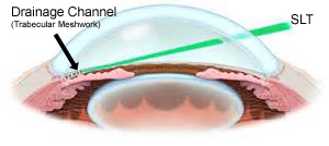 Selective Laser Trabeculoplasty (SLT) for Glaucoma – South Bay ...